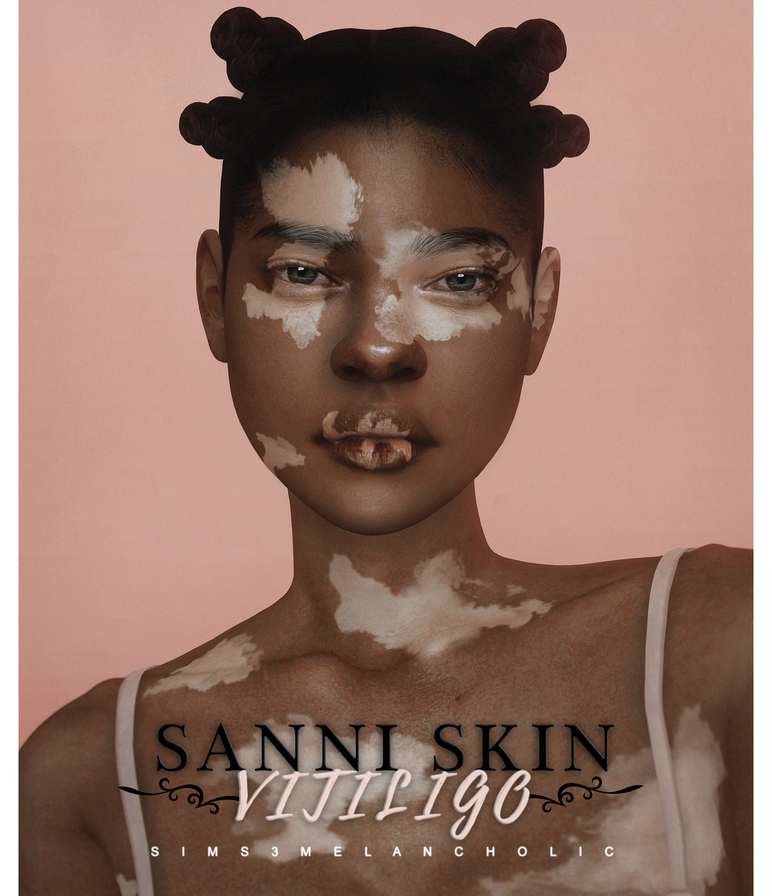 vitiligo cc